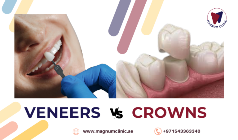 Veneers VS Crowns - pros and cons, difference between veneers and crowns