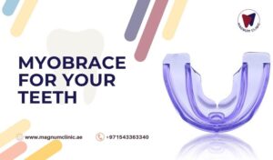 Myobrace Treatment, Benefits, and Cost. Myobrace Before and After