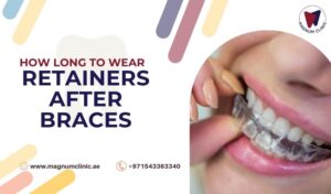 Retainers After Braces: How Long to Wear Retainers After Braces Guide