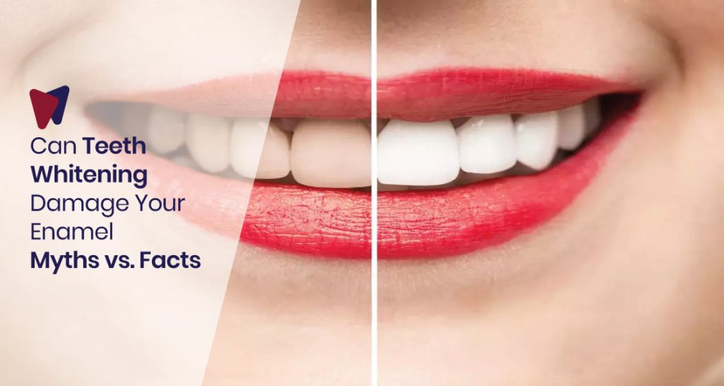 Can Teeth Whitening Damage Your Enamel? Myths Vs. Facts