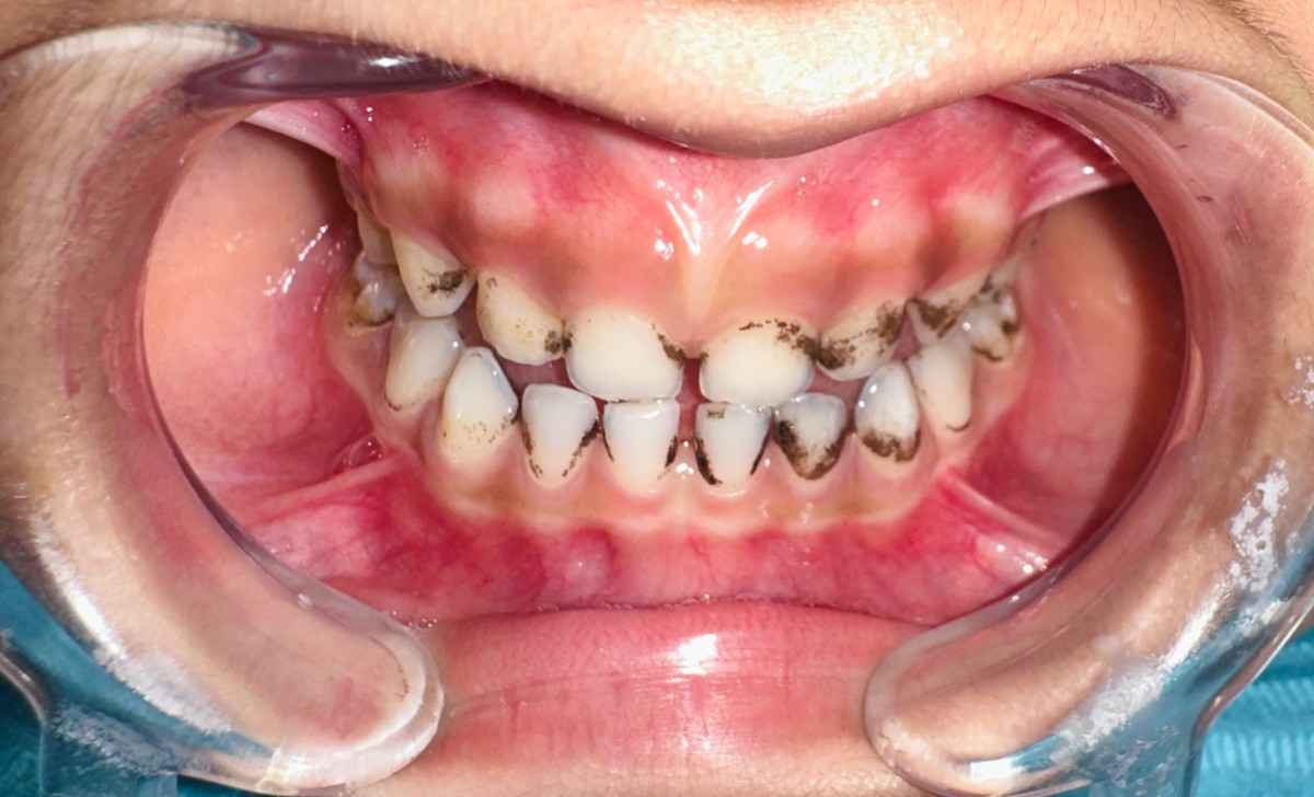 Case Study | Black Stains on Kids' Teeth at Magnum Clinic, Dubai