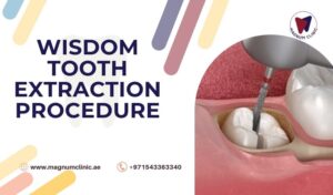 Step-By-Step Breakdown of Wisdom Tooth Extraction Procedure