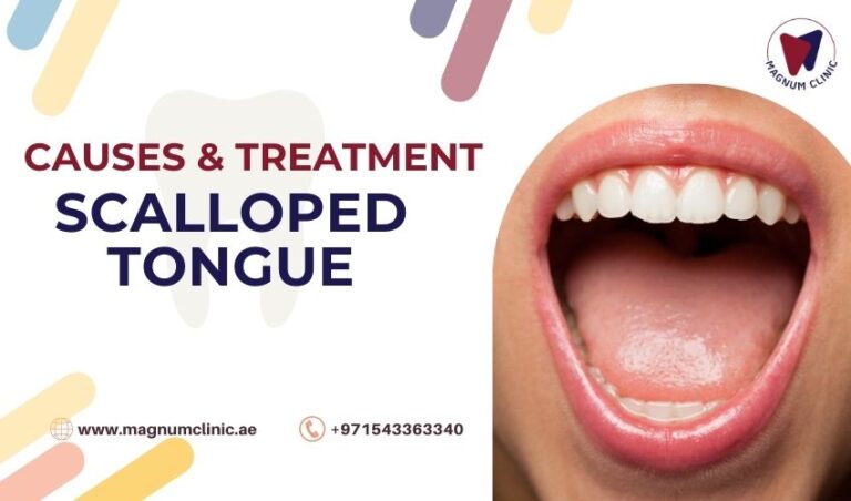 Scalloped Tongue: Causes, Treatment, and Diagnosis