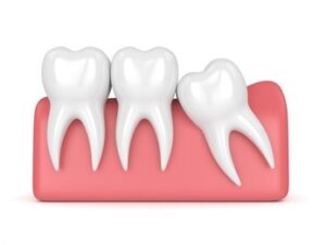 6 Different Types of Impacted Wisdom Teeth | Magnum Clinic