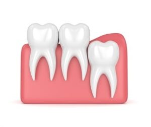 6 Different Types of Impacted Wisdom Teeth | Magnum Clinic